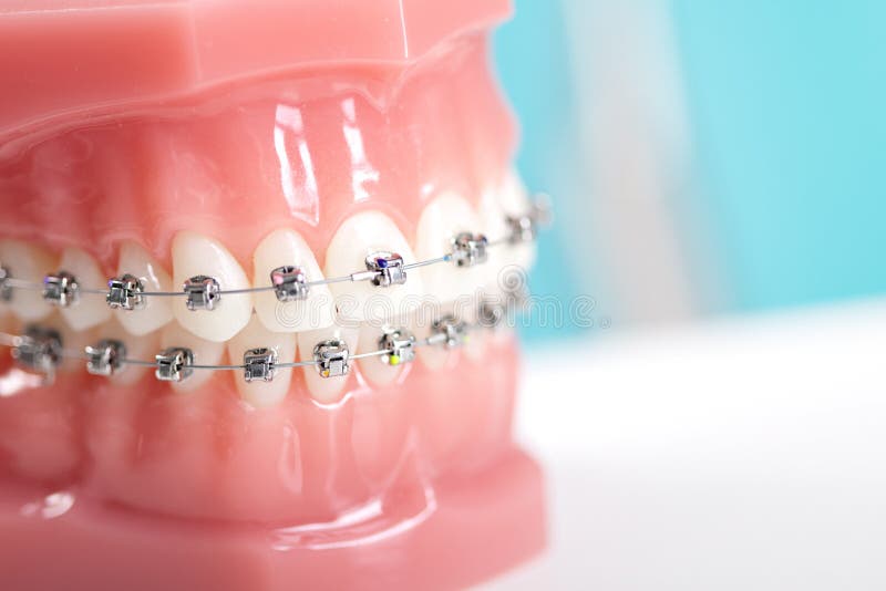 Turquoise Braces stock photo. Image of detail, happy, fashion - 7644098