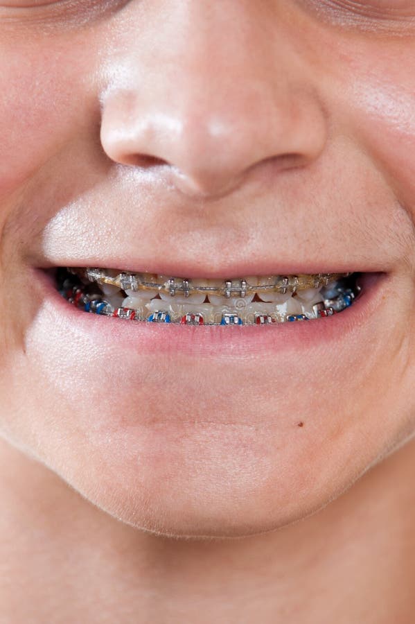 Braces stock photo. Image of teeth, open, care, orthodontics - 23536624
