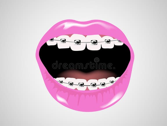 Braces Smile Woman Stock Illustrations – 627 Braces Smile Woman Stock ...