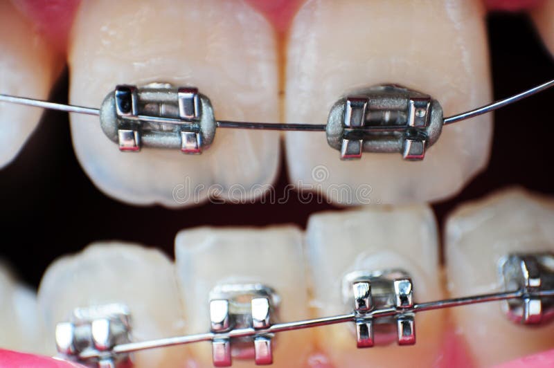 Unaligned Teeth Stock Photos - Free & Royalty-Free Stock Photos from ...