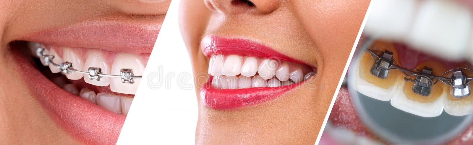 Teeth Collage of People Smiles Stock Photo - Image of teeth, dentistry ...