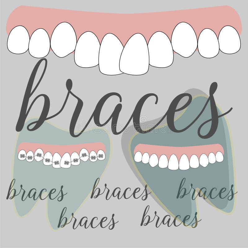 Braces Dentistry in Beautiful Style. Vector Flat Design Illustration ...