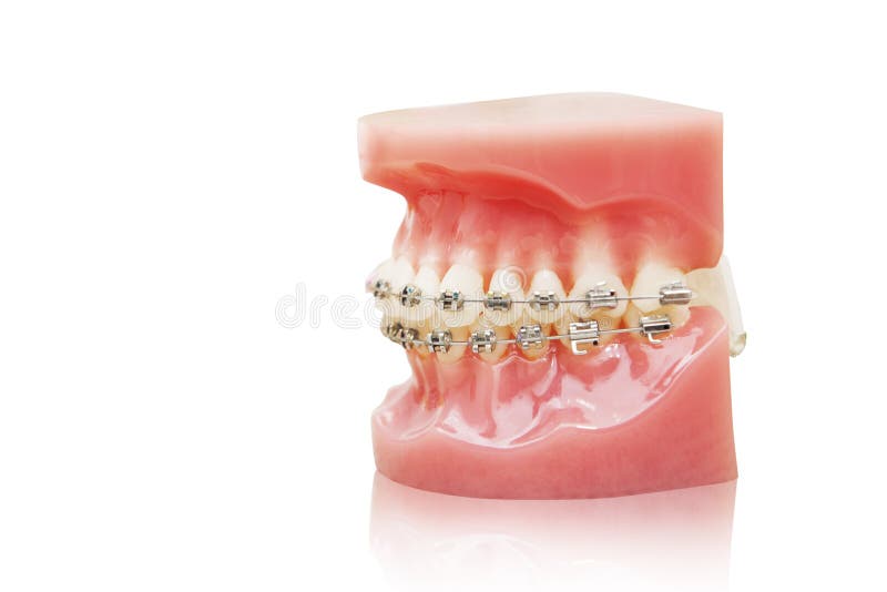 Braces model stock image. Image of brackets, orthodontic - 26450259