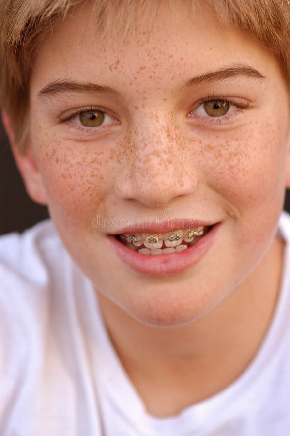 Braces with Smile stock photo. Image of freckles, dental - 9134338