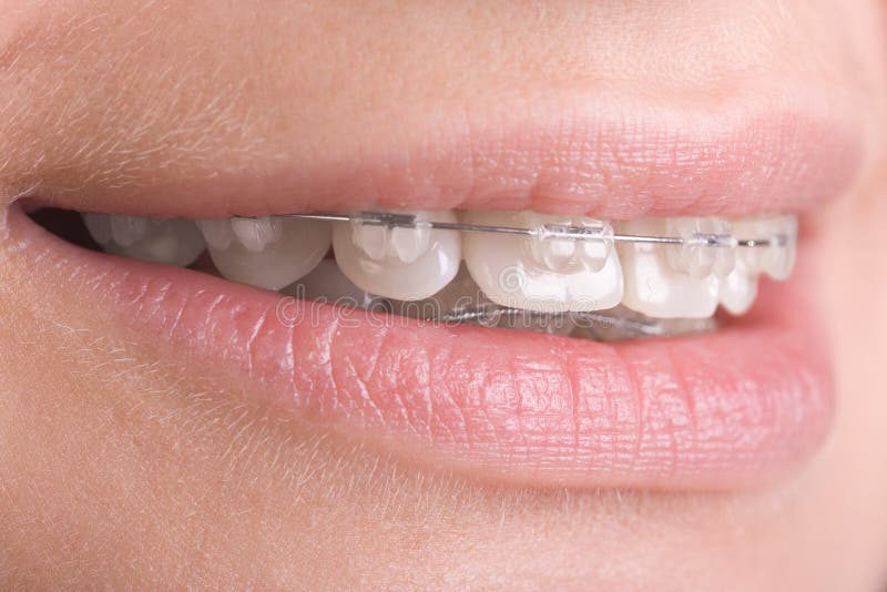 Braces on teeth stock photo. Image of silver, smile, orifice - 3592588