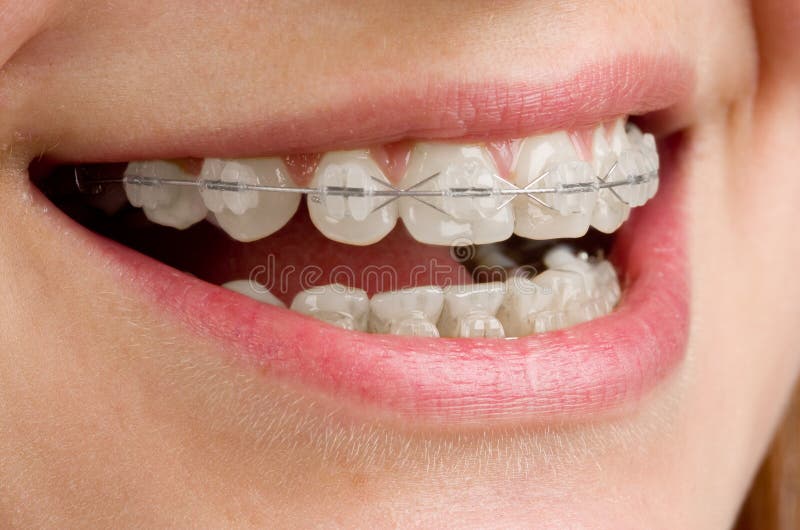 Braces on teeth stock photo. Image of facial, braces, grinning - 8711580