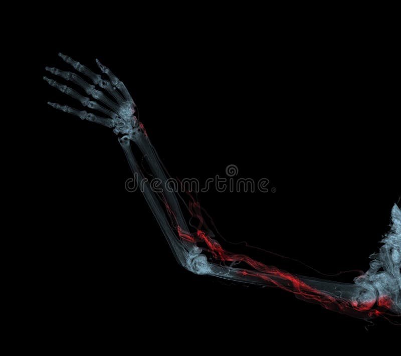 Brachial Arteries of the Arm with Upper Extremity Bone 3D Rendering ...