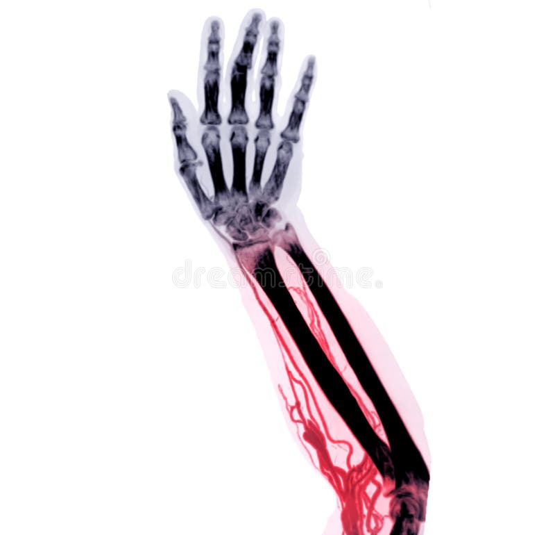 Cta Brachial Artery Or Ct Scan Of Upper Extremity 3d Rendering Image