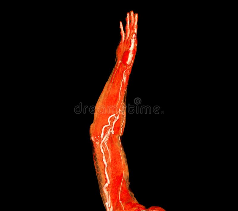 Brachial Arteries of the Arm with Upper Extremity Bone 3D Rendering ...