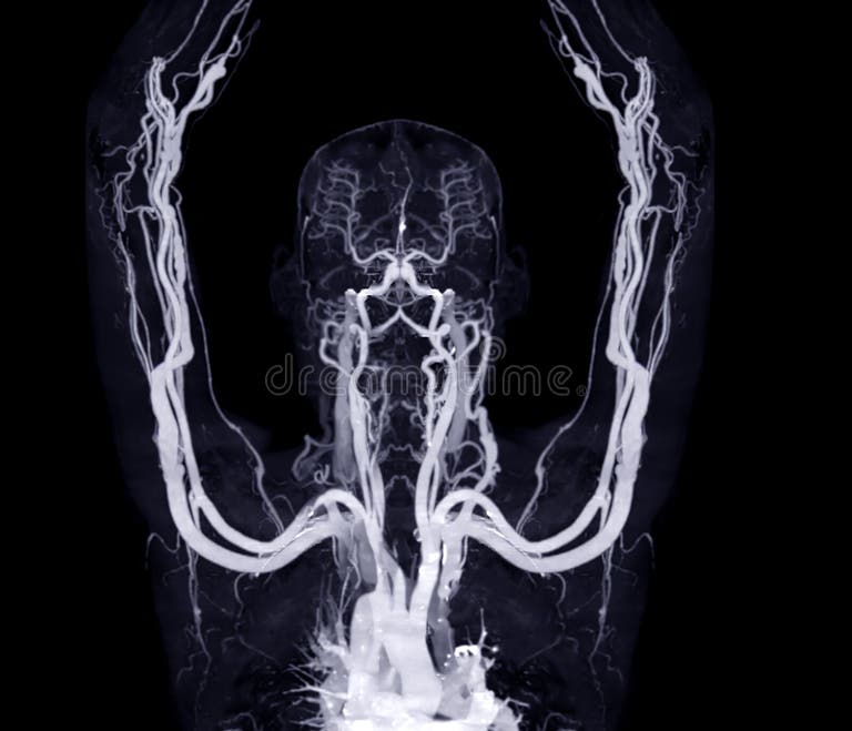 Brachial Arteries of the Arm with Upper Extremity Bone 3D Rendering ...