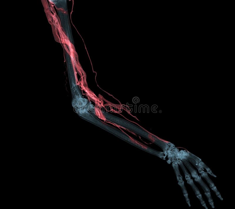 Brachial Arteries of the Arm with Upper Extremity Bone 3D Rendering ...