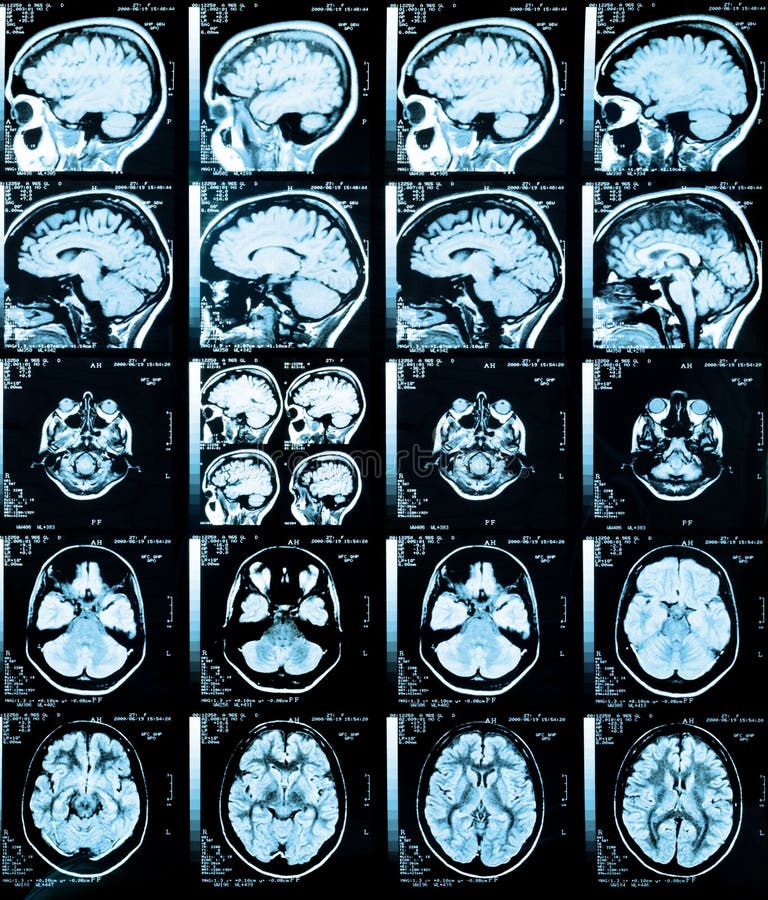 MRI of brain, MR stock photo. Image of medicine, test - 15835152