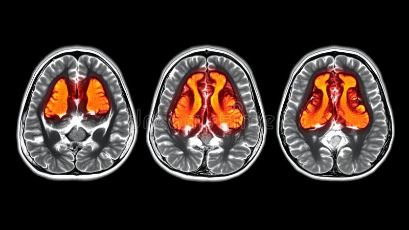 Brain Activity Highlighted in PETCT Scan Images, for Medical ...
