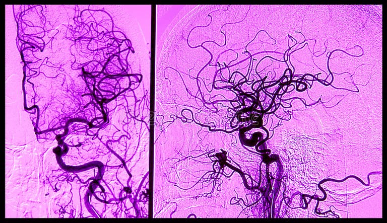 Brain Angiograhy, Arteriography Stock Image - Image of medical ...