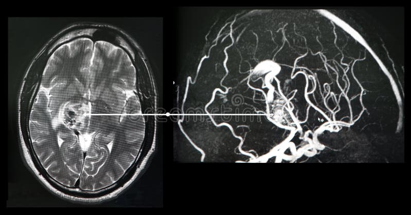 Brain Angiography. CT-scan Reconstruction. Malformation Stock Image ...