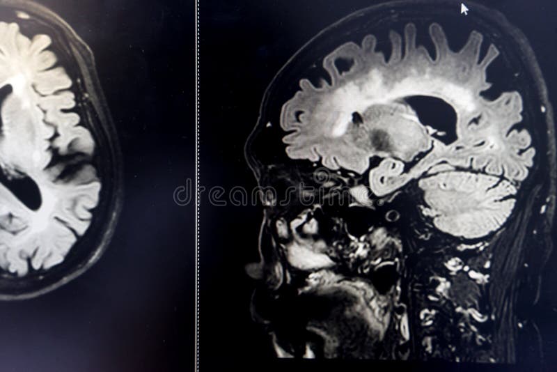 Brain Atrophy for Education and Diagnostic Stock Photo - Image of ...
