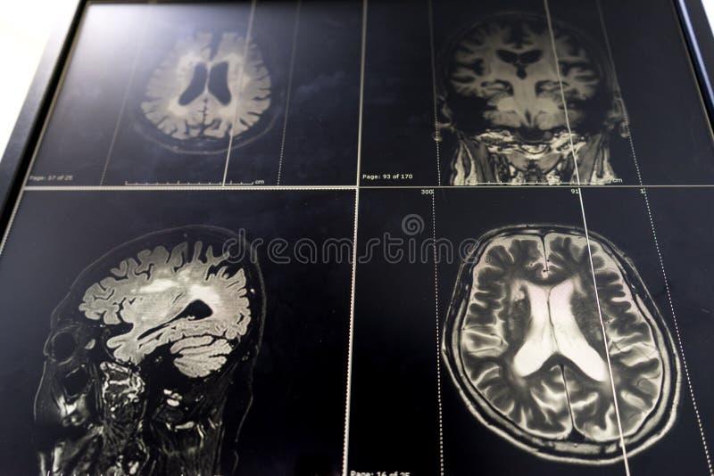 Brain Atrophy for Education and Diagnostic Stock Image - Image of ...