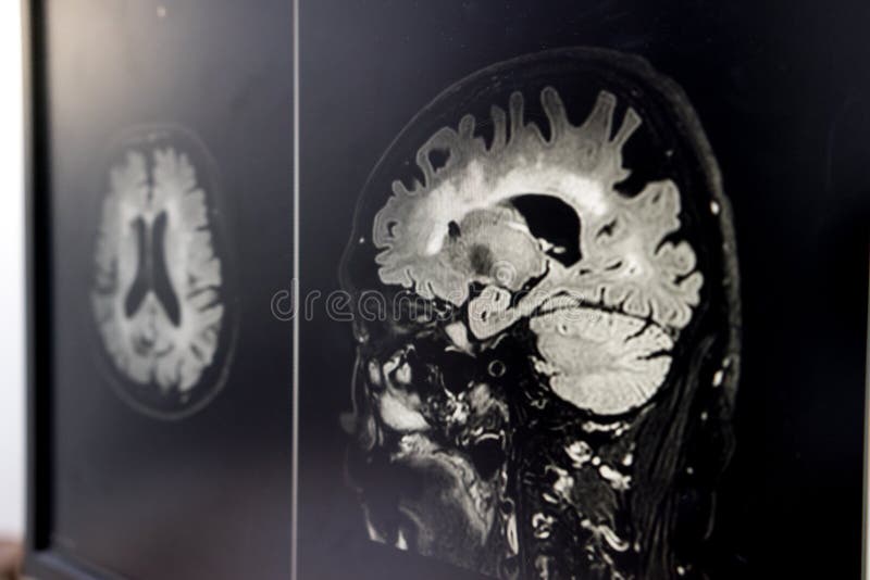 Brain Atrophy for Education and Diagnostic Stock Photo - Image of ...
