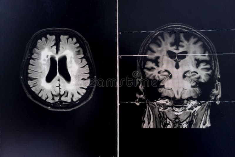 Brain Atrophy for Education and Diagnostic Stock Photo - Image of ...