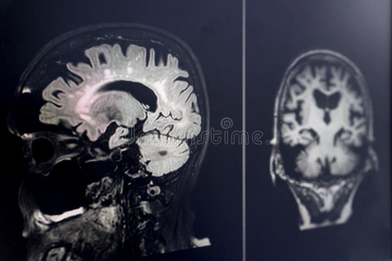 Brain Atrophy for Education and Diagnostic Stock Photo - Image of ...