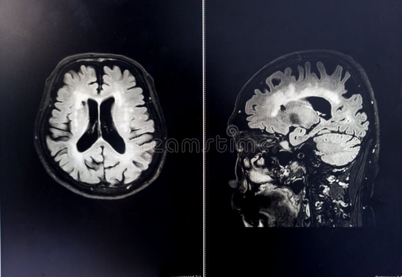 Brain Atrophy for Education and Diagnostic Stock Image - Image of ...