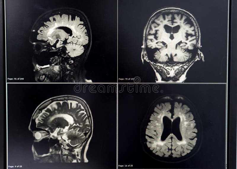 Brain Atrophy for Education and Diagnostic Stock Photo - Image of ...