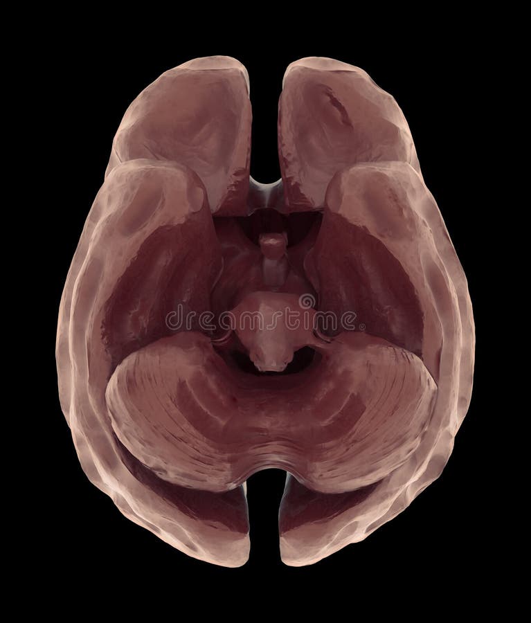 Brain Atrophy or Severe Shrinkage Av Brain Caused by Dementia and ...