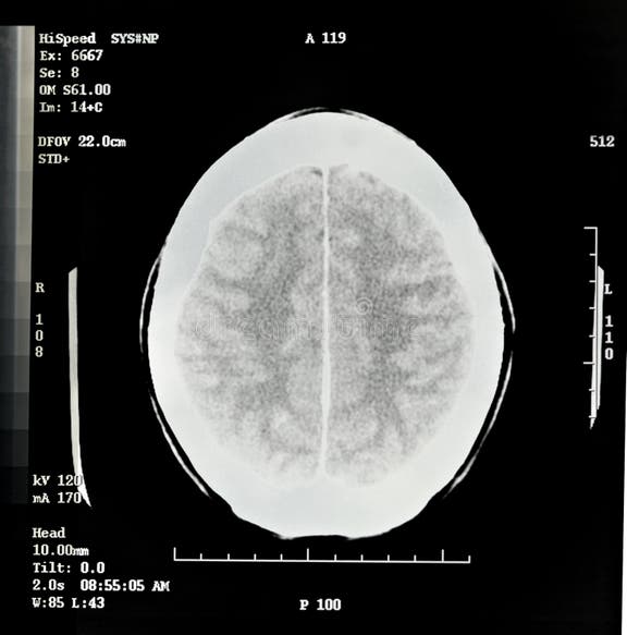 Brain CAT Scan stock image. Image of iodine, axial, brains - 6743491