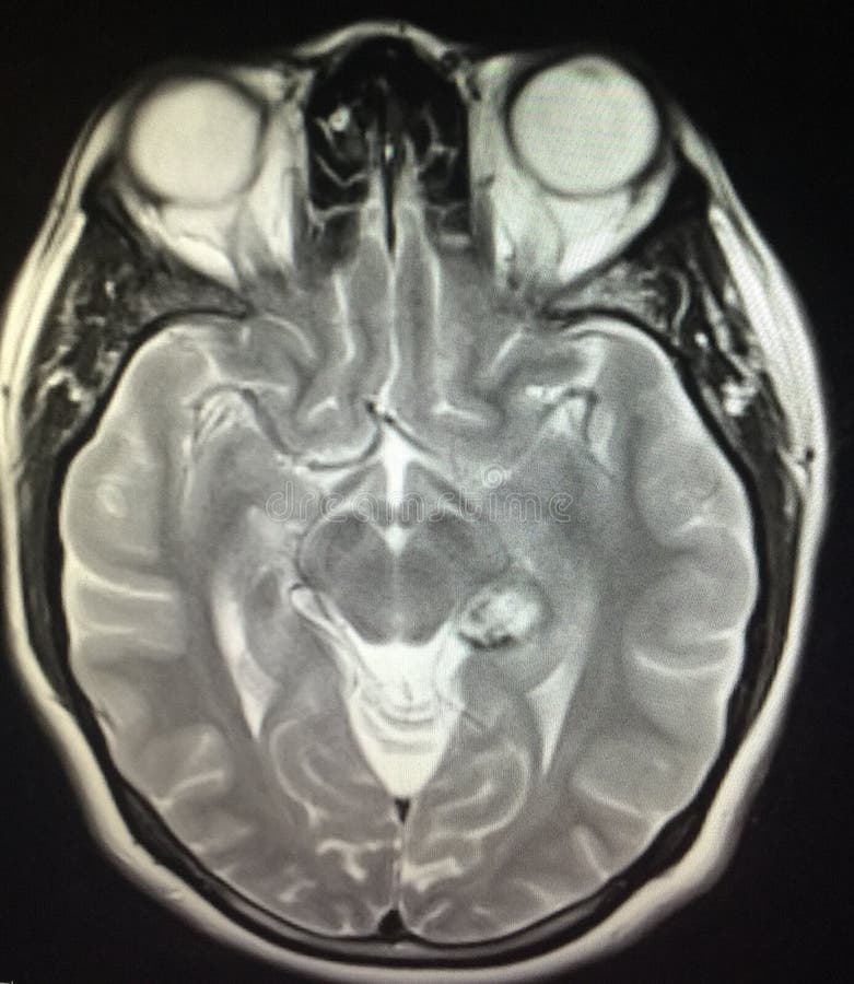 Brain Cavernous Malformation Pathology Mri Exam Stock Image - Image of ...