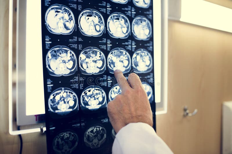 Brain CT scan x-ray film stock photo. Image of healthcare - 115692080