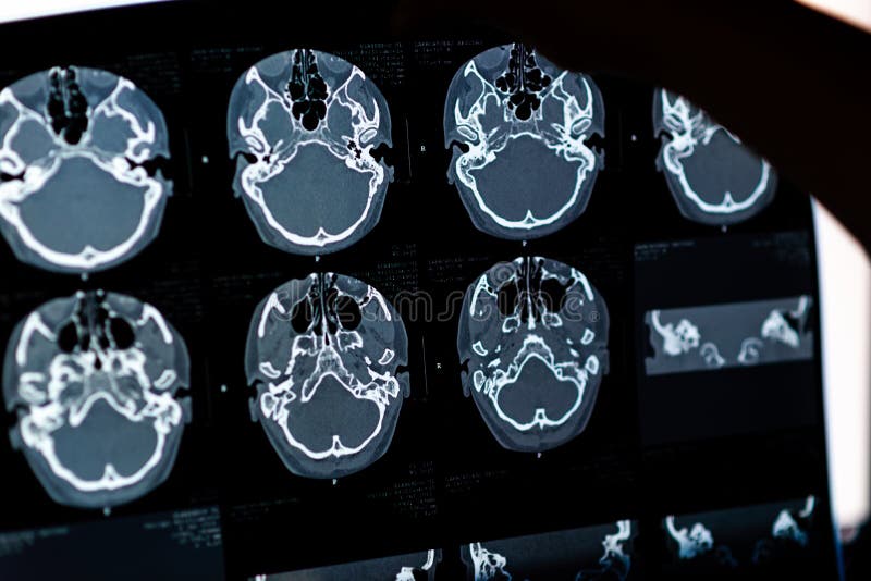Brain CT Scan X-ray Film Image Brain Stock Image - Image of aneurysm ...