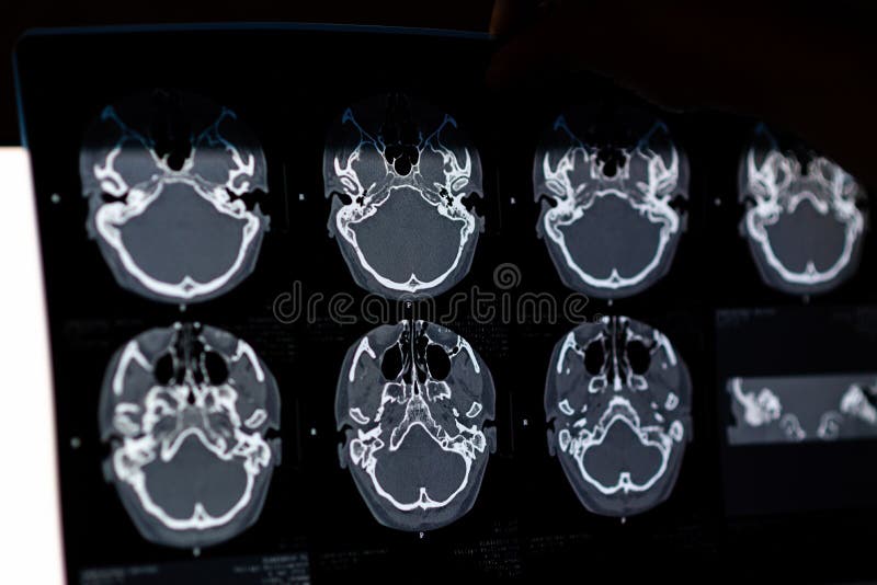 Brain CT Scan X-ray Film Image Brain Stock Photo - Image of ischemic ...