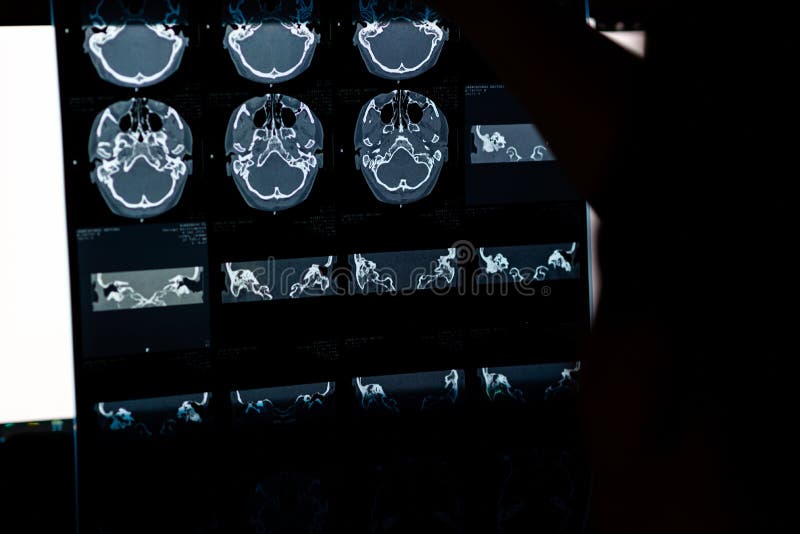 Brain CT Scan X-ray Film Image Brain Stock Photo - Image of hemorrhagic ...