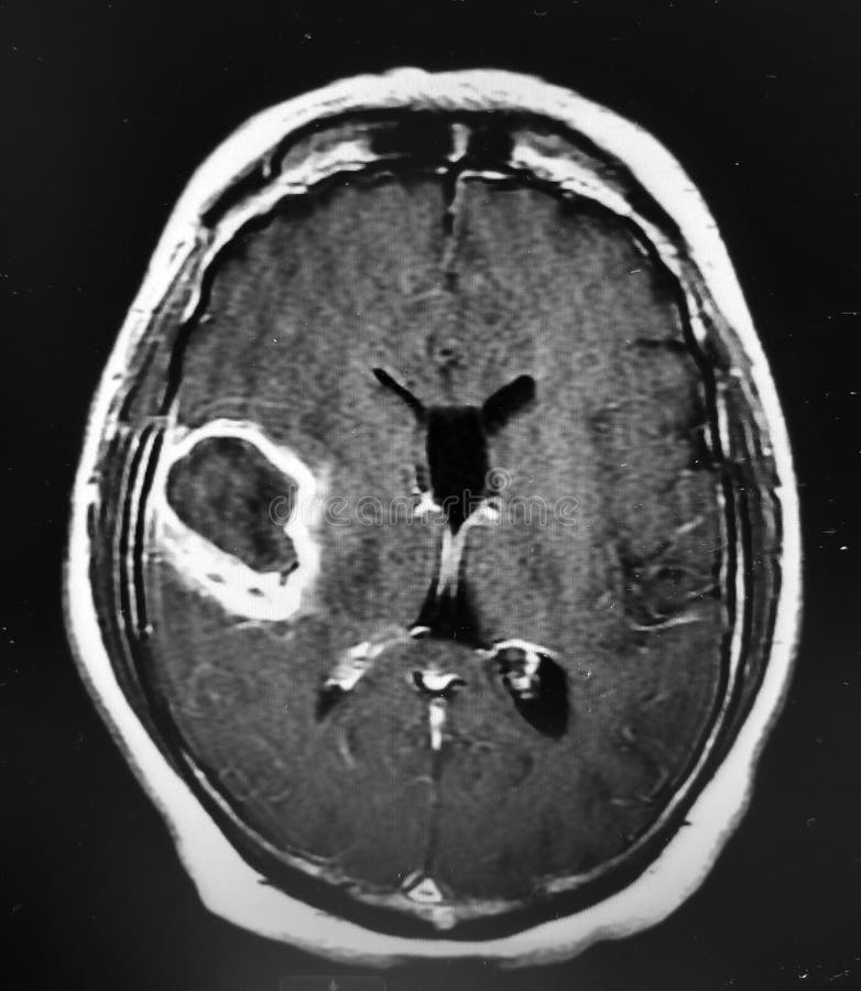 Brain CT Showing E. Coli Brain Abscess Stock Image - Image of enhance ...