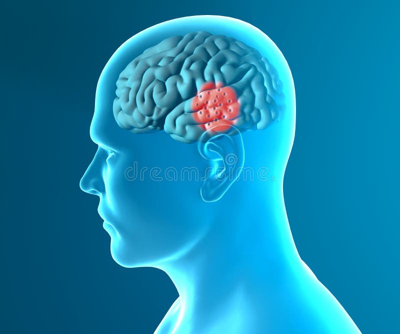 Brain Degenerative Diseases Parkinson Stock Illustration - Illustration ...