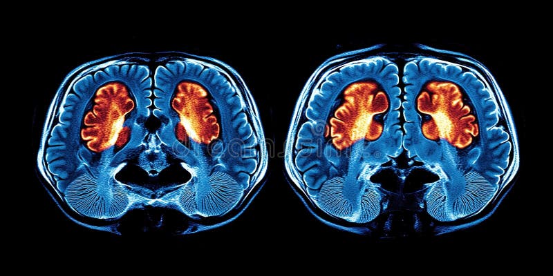 Brain Imaging Reveals Distinct Regions of Activity in a Functional MRI ...