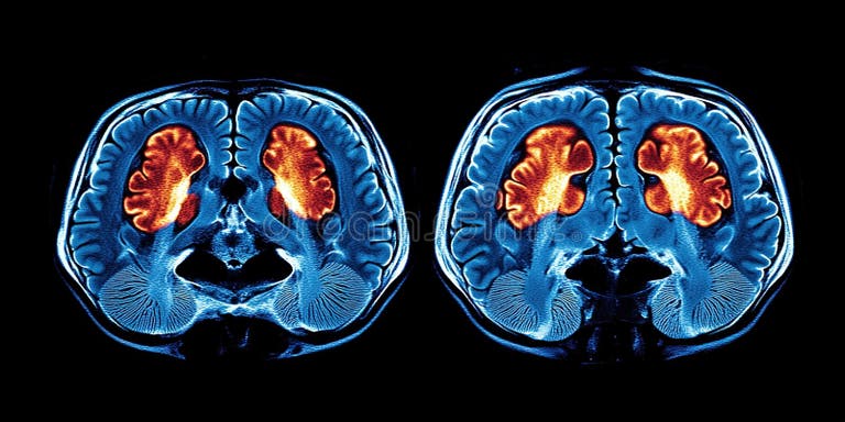 Brain Imaging Reveals Distinct Regions of Activity in a Functional MRI ...