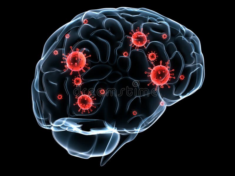 Brain infection stock illustration. Illustration of disease - 8692484