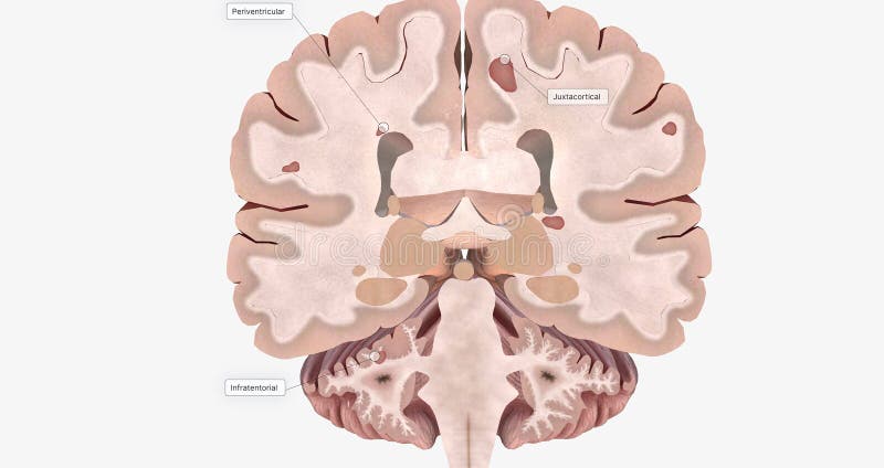 The Brain with lesions 3D stock illustration. Illustration of medical ...