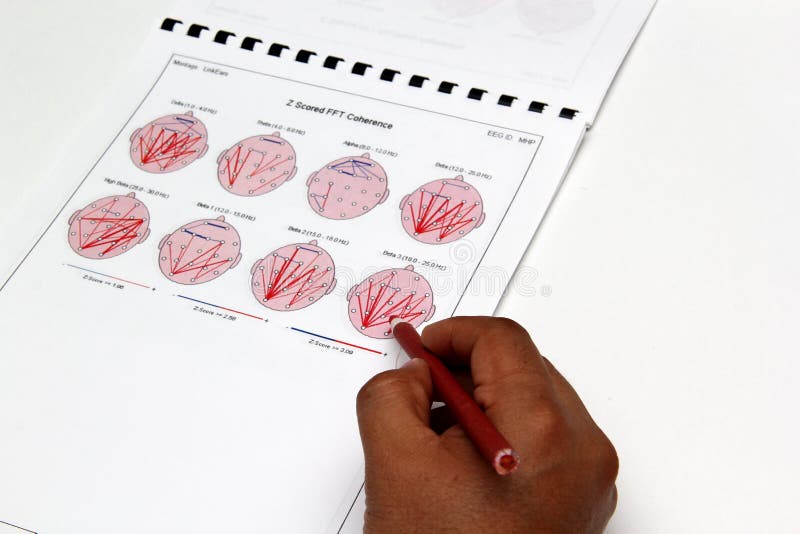 Brain Mapping Done by a Neurologist Doctor with Neuroscience Technique ...