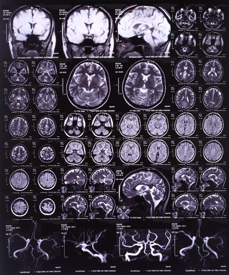 1+ Brain injury mri Free Stock Photos - StockFreeImages
