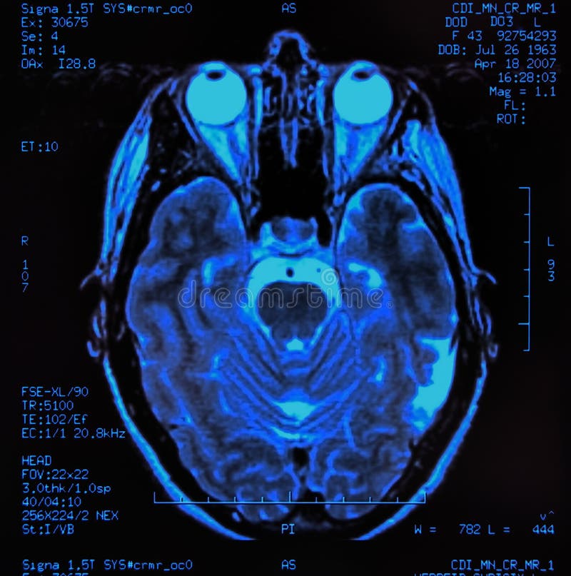MRI of brain and cranium stock image. Image of care, bones - 2241555