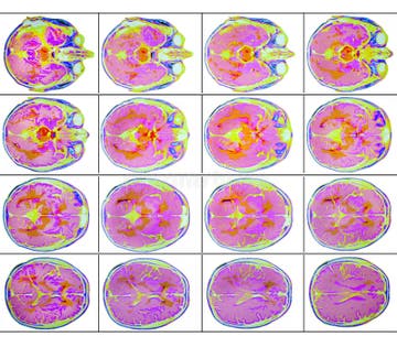 112 Brain Color Mri Stock Photos - Free & Royalty-Free Stock Photos ...