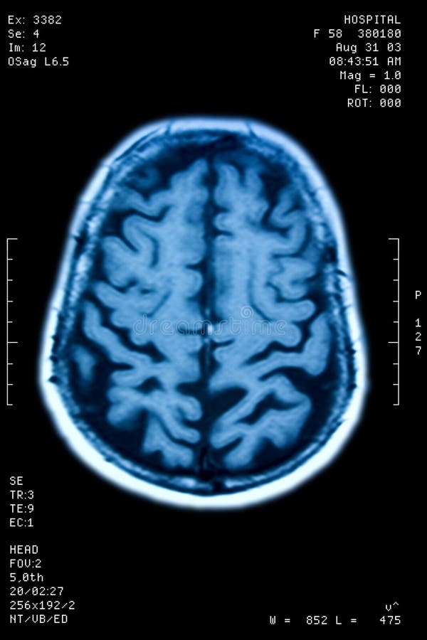Brain MRI Scan Mouse Wheel stock image. Image of dementia - 14815303