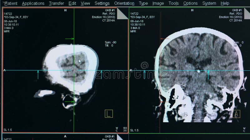 Brain Scanning during an MRI Procedure Stock Video - Video of ...