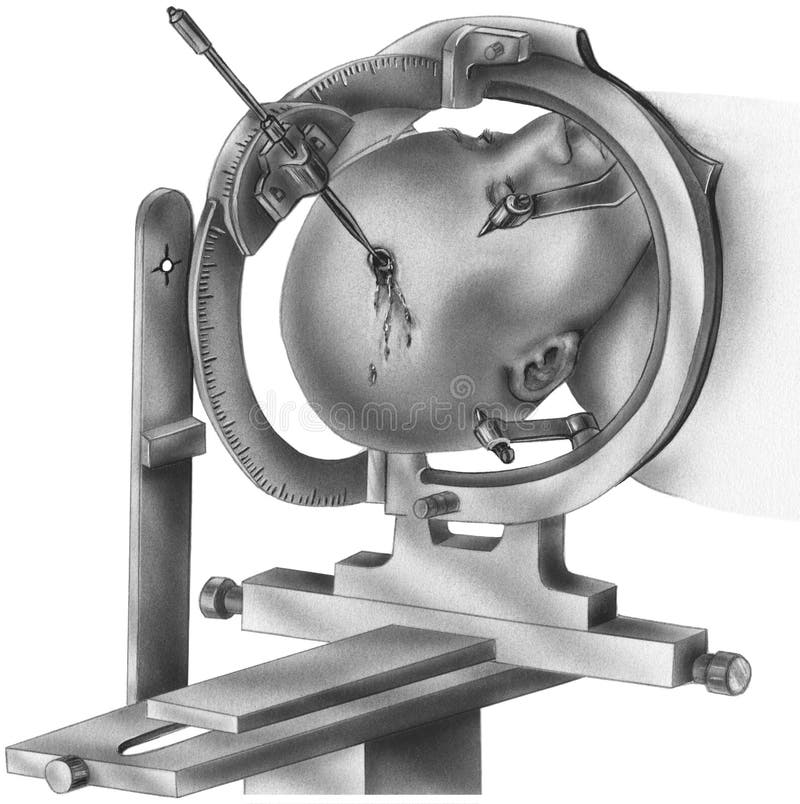 Brain - Stereotactic Probe and Surgery Stock Illustration ...