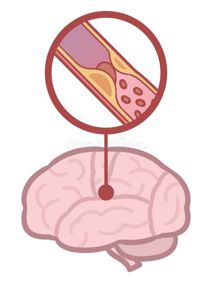 Brain Stroke - Cerebral Infarction Illustration Stock Vector ...