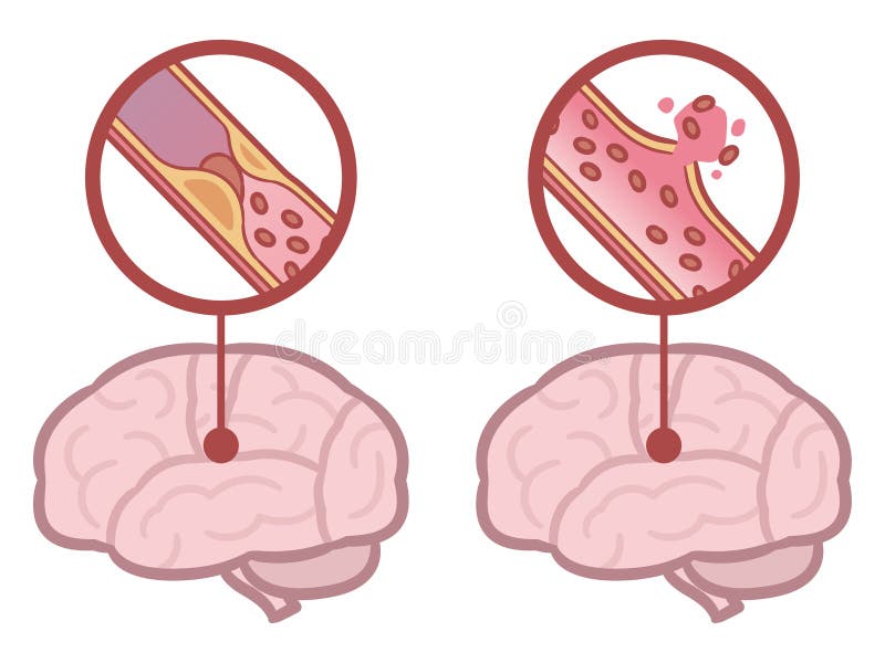 Brain Stroke - Ischemic and Hemorrhagic Stock Vector - Illustration of ...