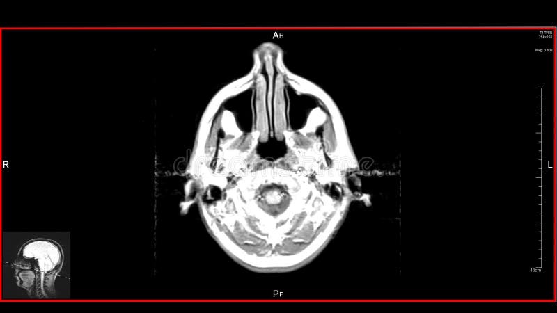 MRT Scan stock photo. Image of hospital, negative, doctor - 15747090