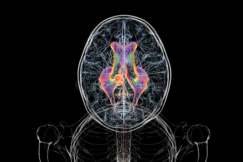 A Brain Tumor Causing Hydrocephalus, 3D Illustration Stock Illustration ...